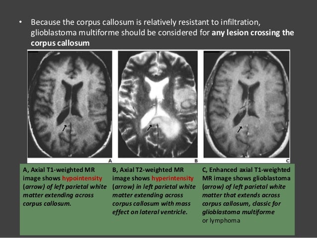 Disorders of corpus callosum