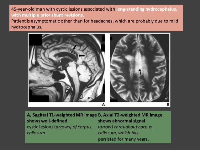 Disorders of corpus callosum