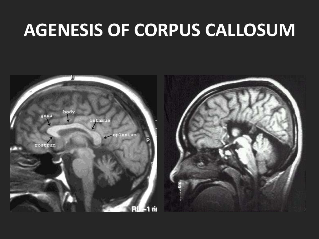 Corpus Callosum