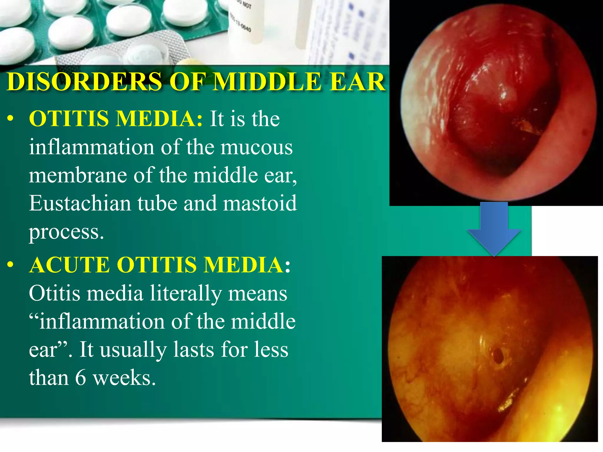 Disorders of ear | PPTX
