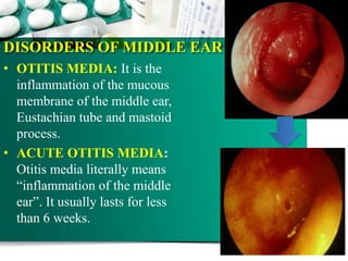 Disorders of ear | PPTX