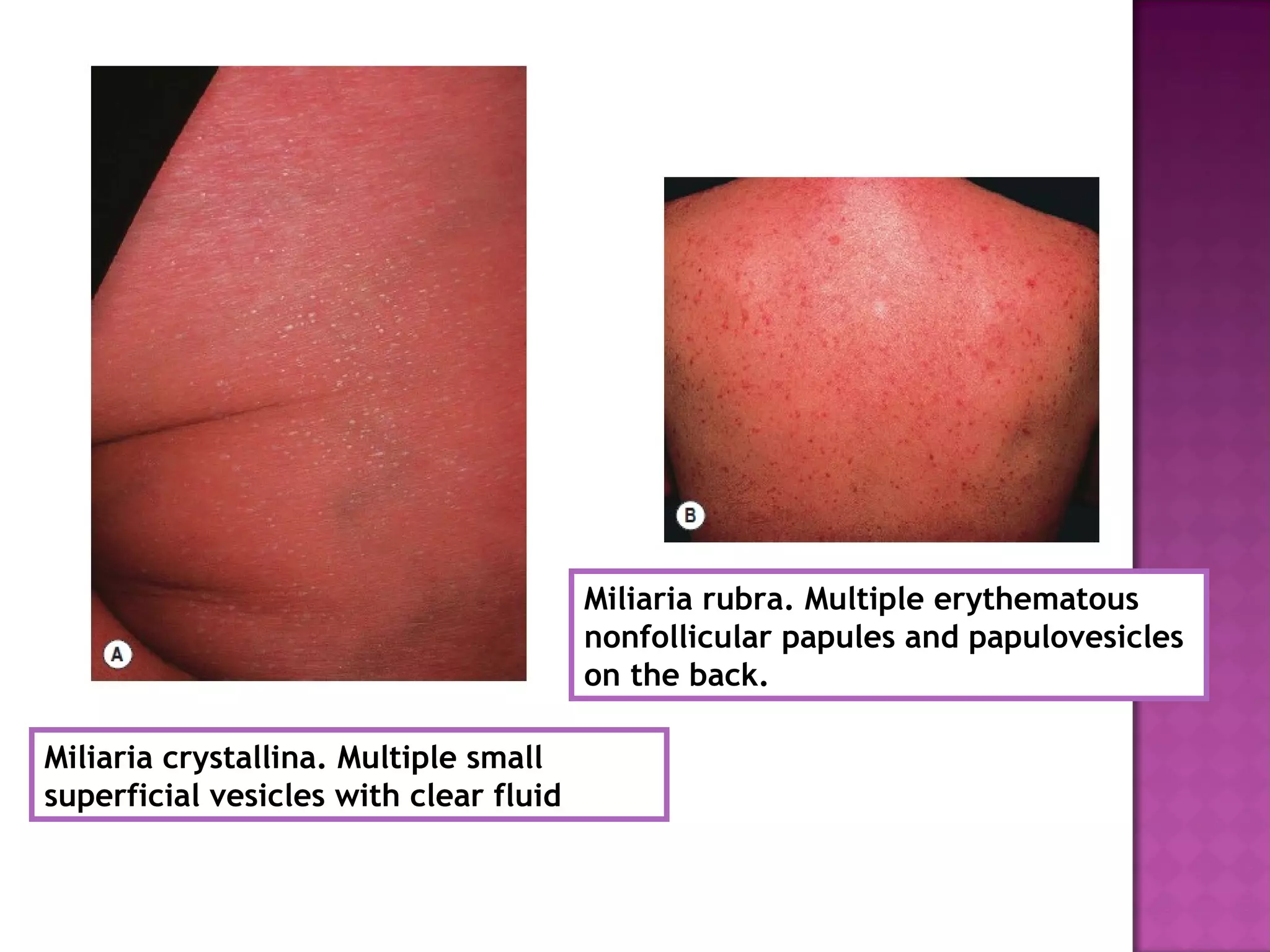 Disorders of Eccrine and Apocrine Sweat Glands | PPT