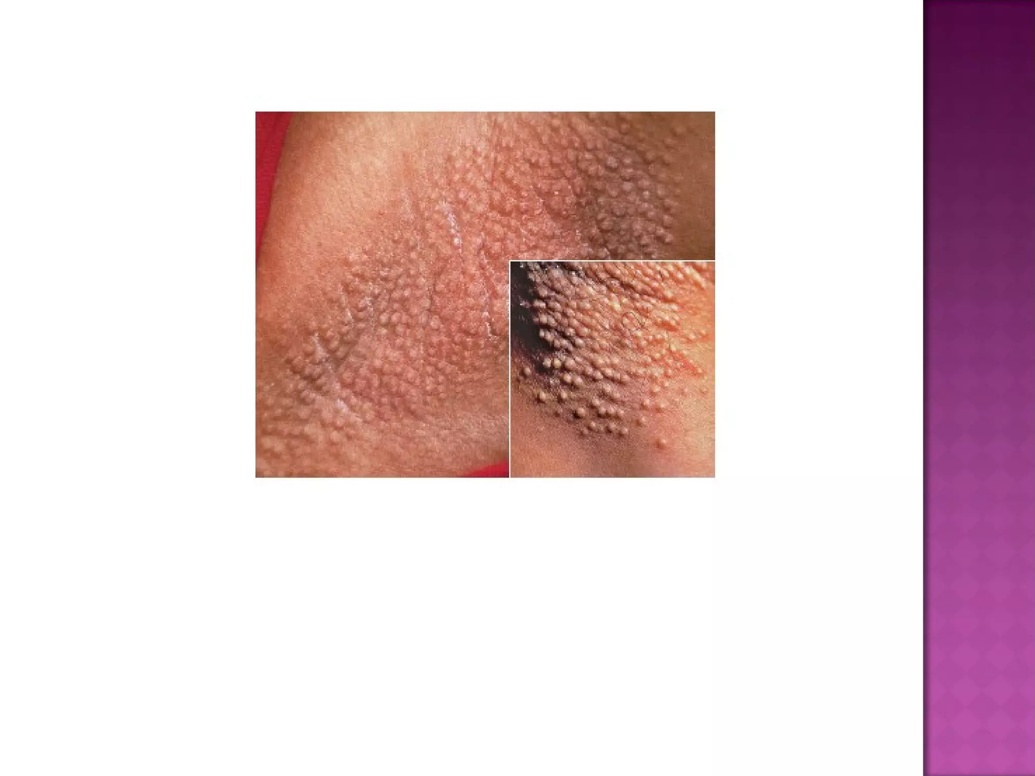 Disorders of Eccrine and Apocrine Sweat Glands | PPT