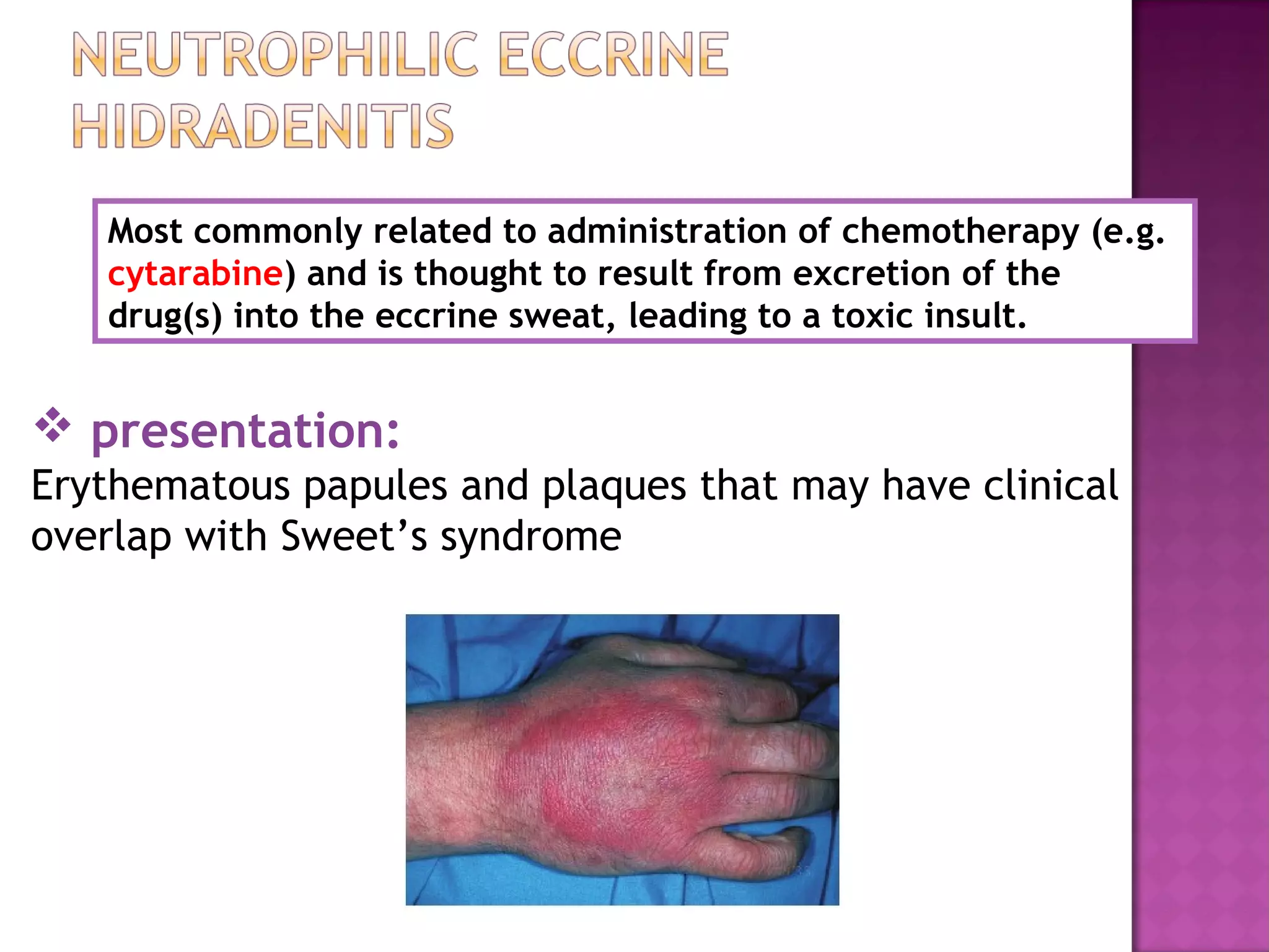 Disorders of Eccrine and Apocrine Sweat Glands | PPT