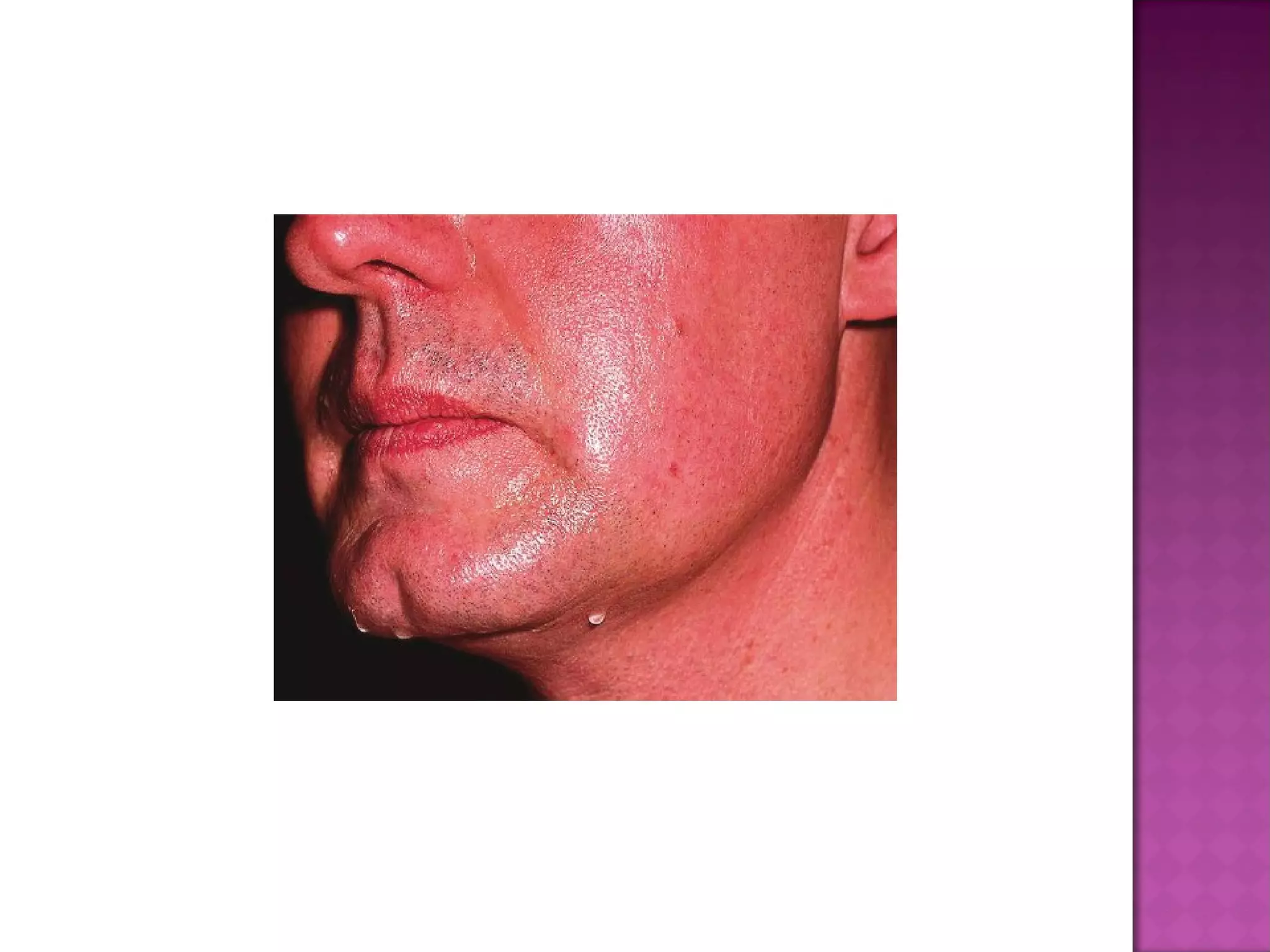 Disorders of Eccrine and Apocrine Sweat Glands | PPT