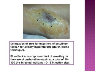 Disorders of Eccrine and Apocrine Sweat Glands | PPT