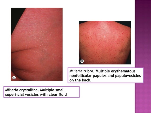 Disorders of Eccrine and Apocrine Sweat Glands | PPT