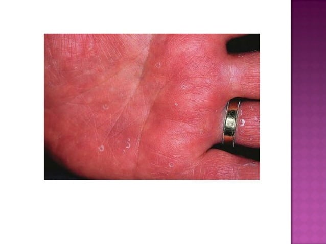 Disorders of Eccrine and Apocrine Sweat Glands | PPT