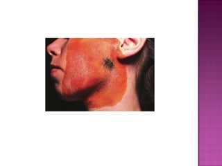 Disorders of Eccrine and Apocrine Sweat Glands | PPT