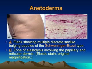 Disorders Of Elastic Tissue | PPS