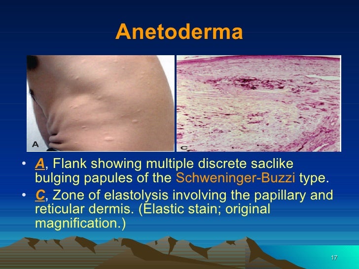 Disorders Of Elastic Tissue