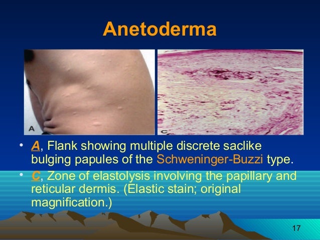 Disordersofelastictissue 100405052552-phpapp01