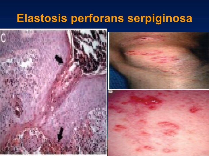 Elastosis Perforans Serpiginosum Clinical Presentation