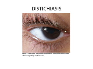 Disorders of eyelid | PPTX