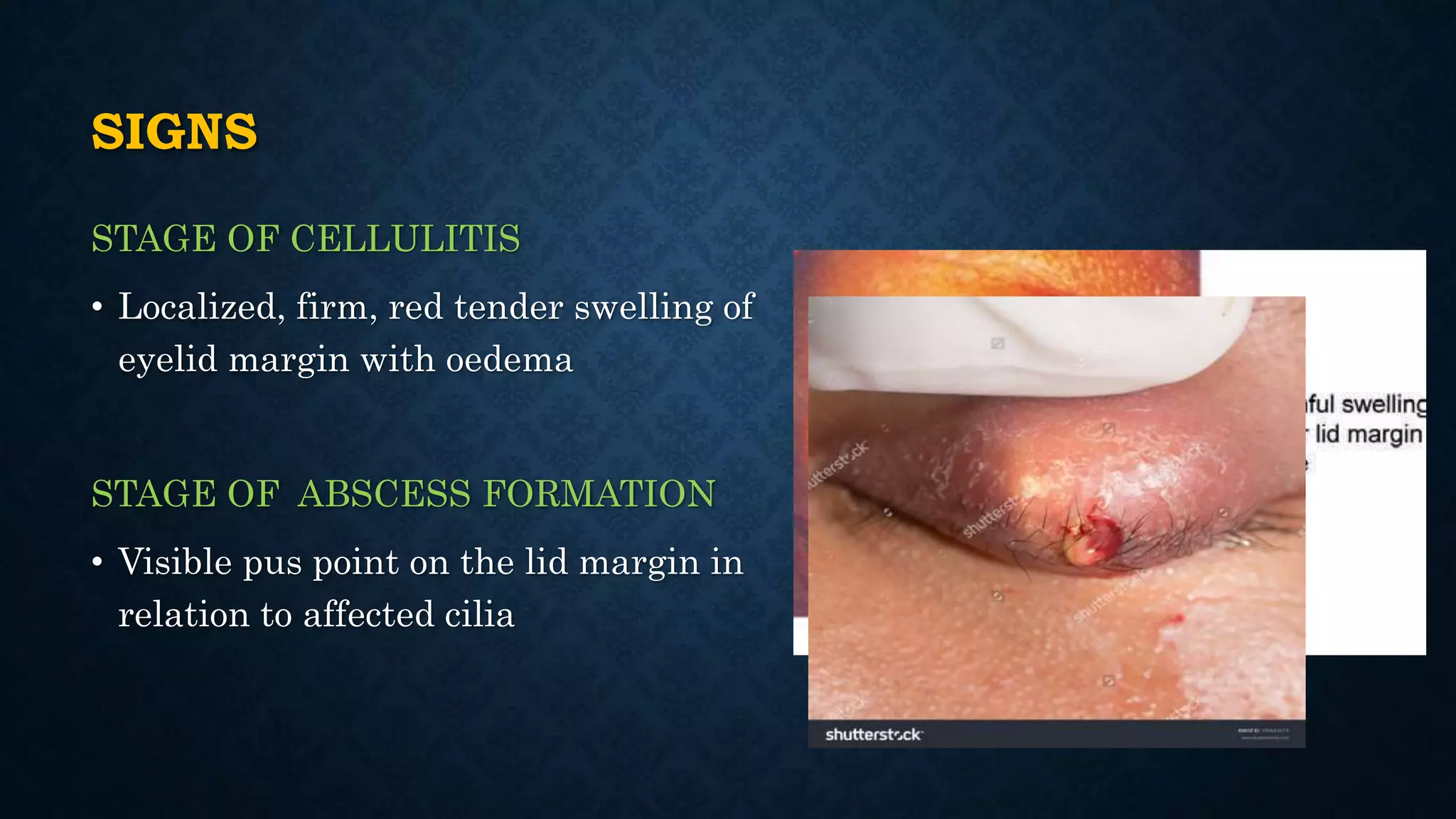 Disorders of eyelids | PPTX