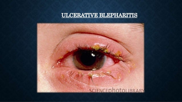 Disorders of eyelids