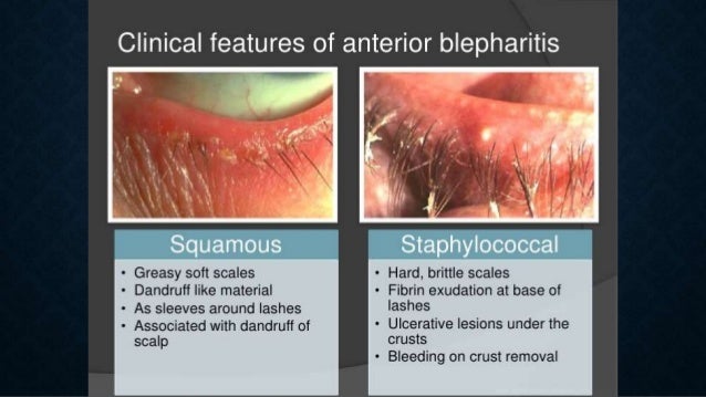 Ulcerative Blepharitis