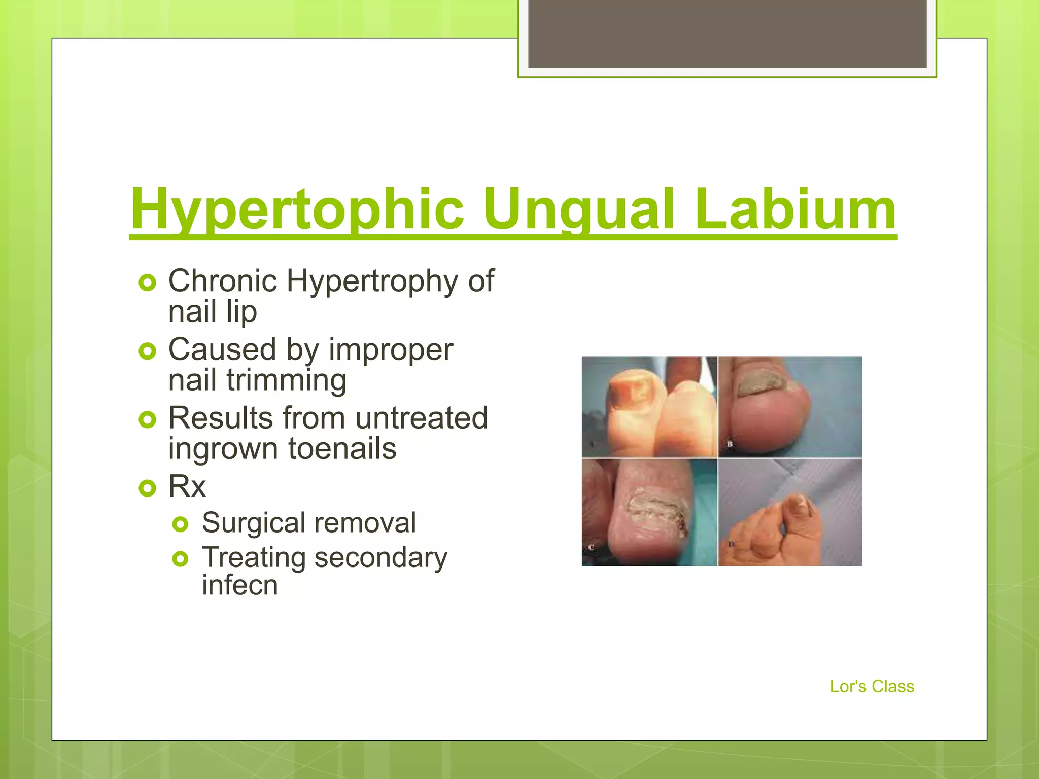 Disorders of feet-Bunion,Marfan Syndrome,Ehlers–Danlos syndrome,Corn ...