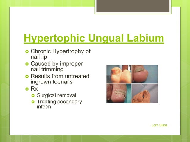 Disorders of feet-Bunion,Marfan Syndrome,Ehlers–Danlos syndrome,Corn ...