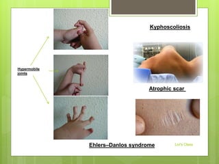 Disorders of feet-Bunion,Marfan Syndrome,Ehlers–Danlos syndrome,Corn ...