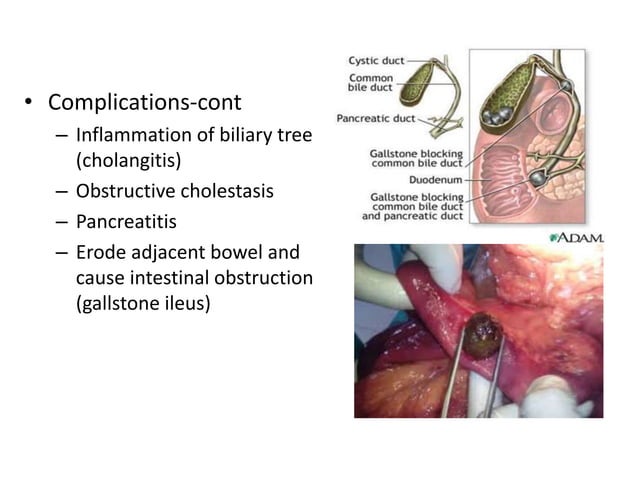 Disorders of gall bladder | PPTX