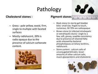 Pigment Gallstones