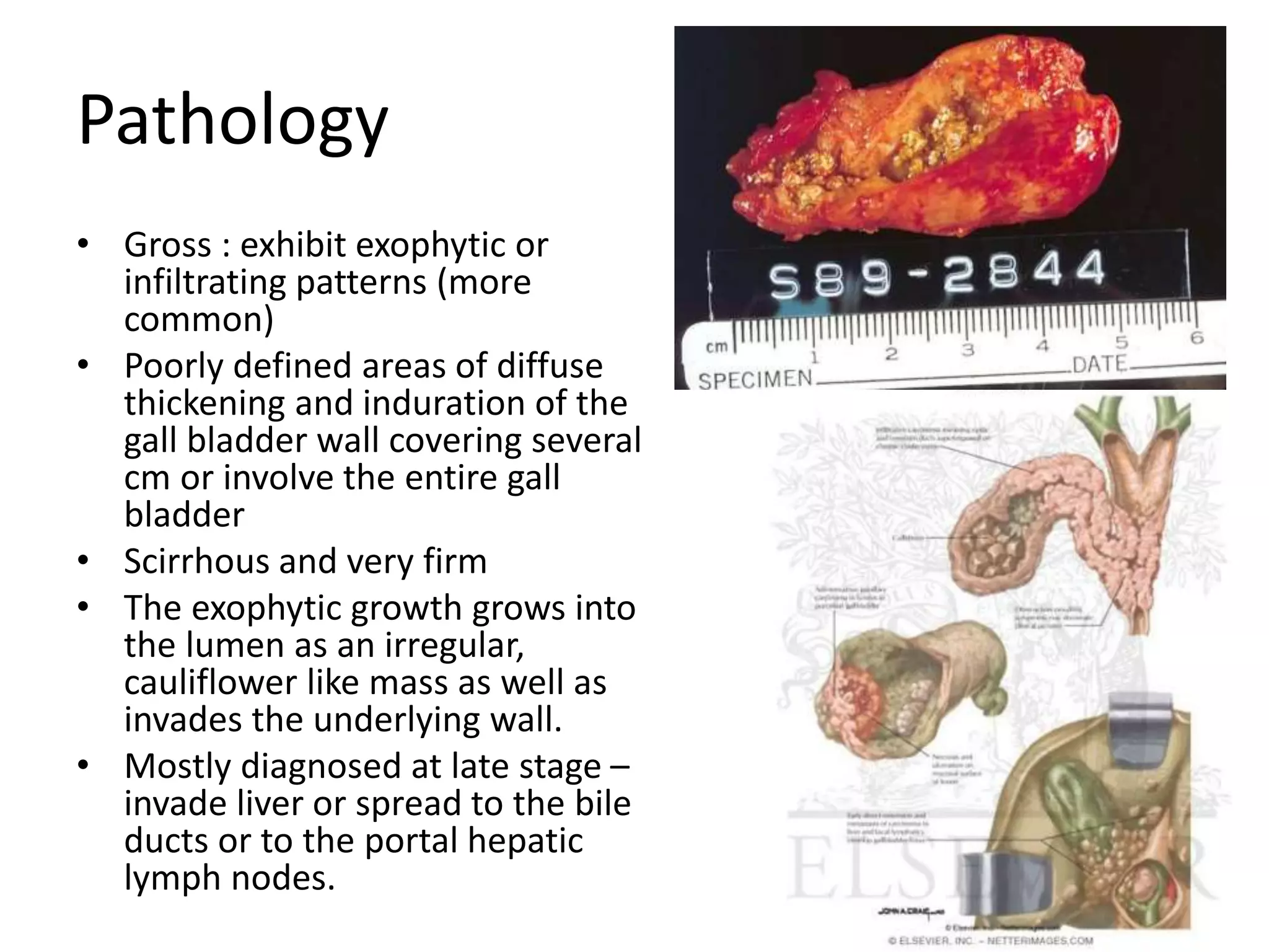 Disorders of gall bladder | PDF