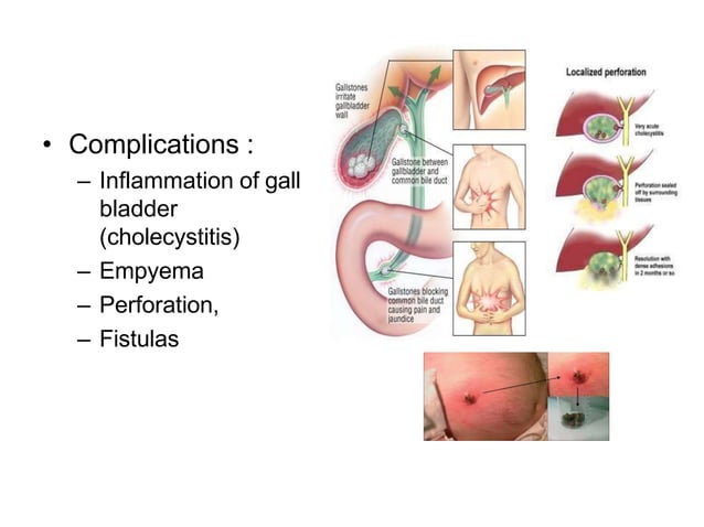 disordersofgallbladder (1).pptx