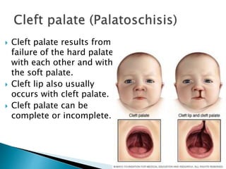 Disorders of gastrointestinal system peds | PPTX