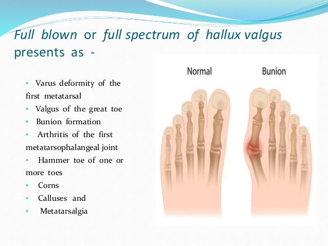 Disorders of hallux