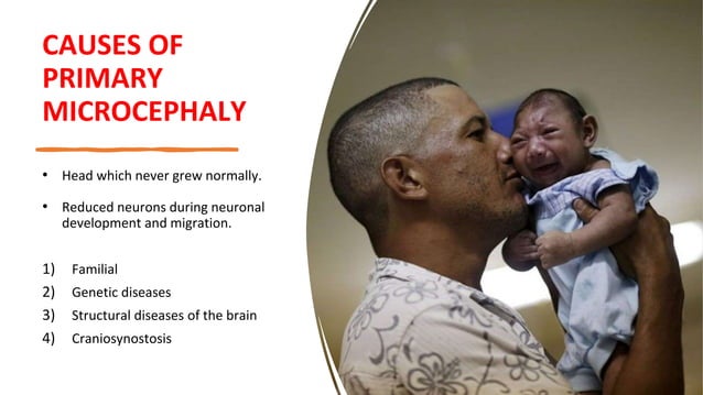 Microcephaly & Macrocephaly | PPTX
