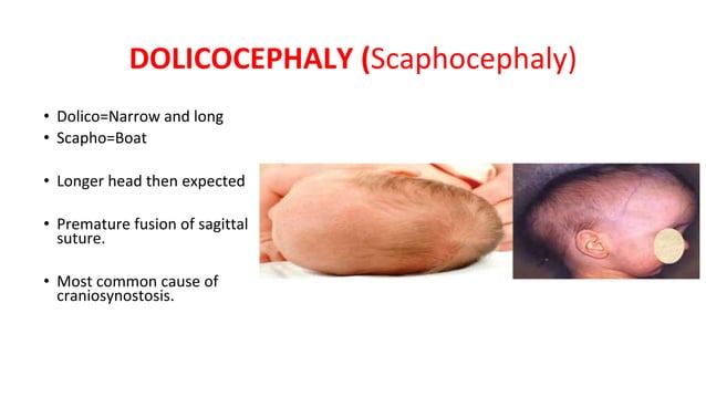 Microcephaly & Macrocephaly | PPTX