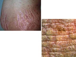 Keratoderma Climactericum