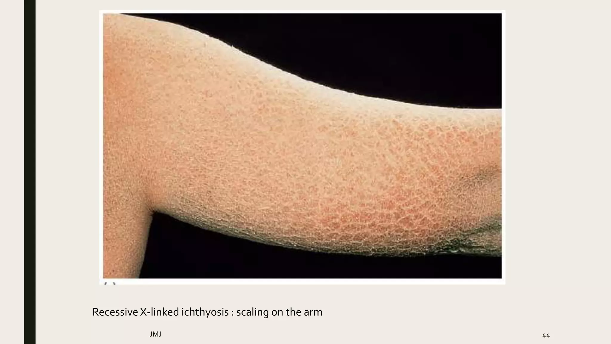 Disorders of keratinization | PPTX