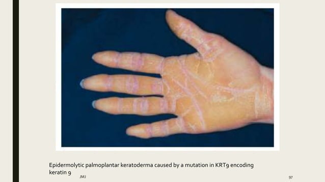 Disorders of keratinization