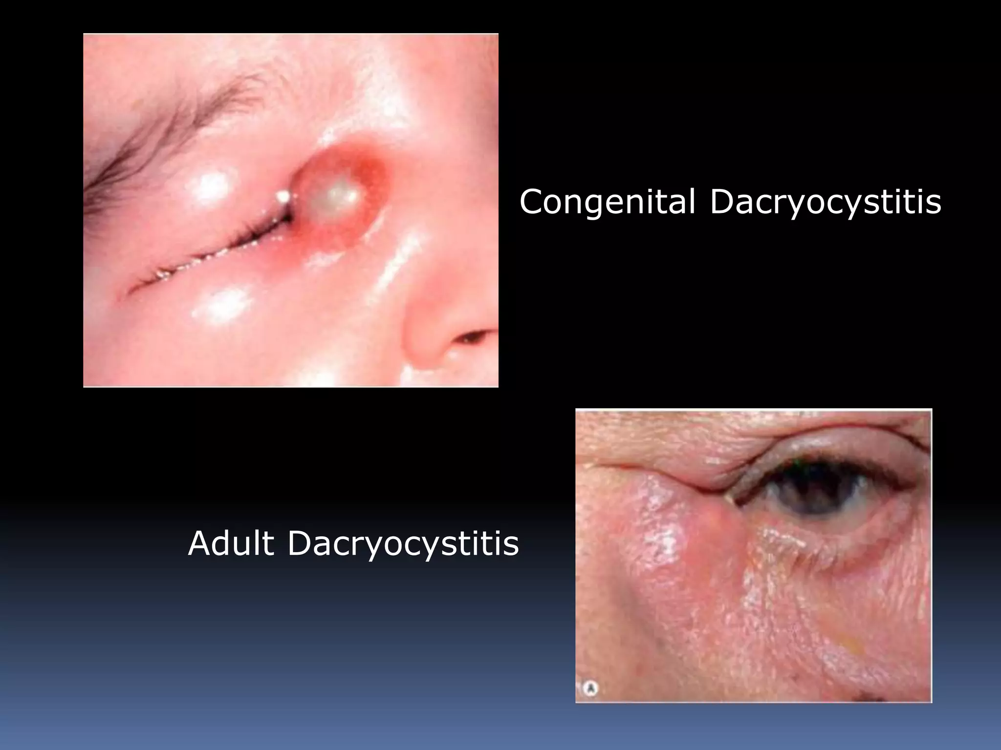 DISORDERS OF LACRIMAL SYSTEM---2.ppt