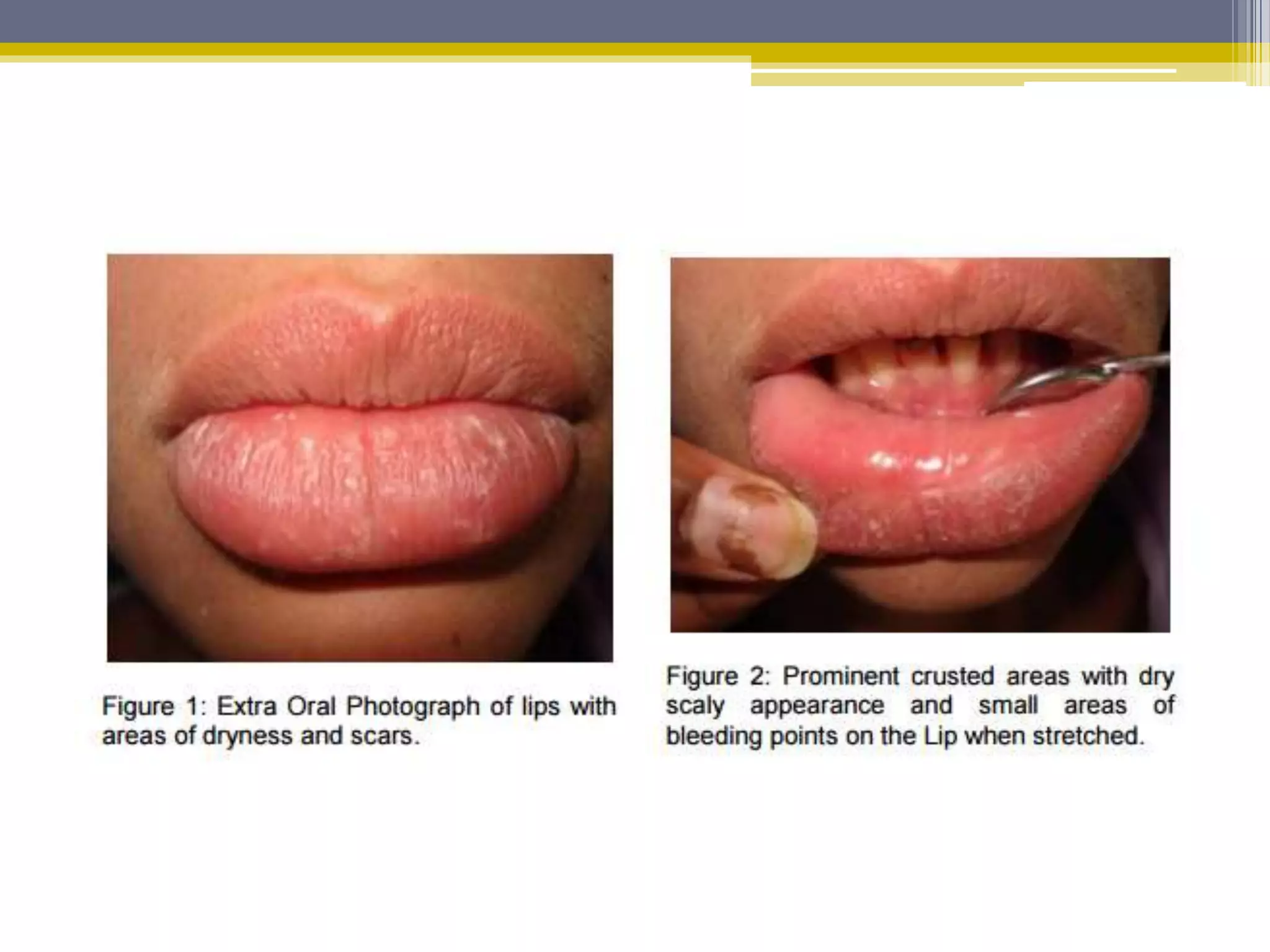 Disorders of lip | PPTX