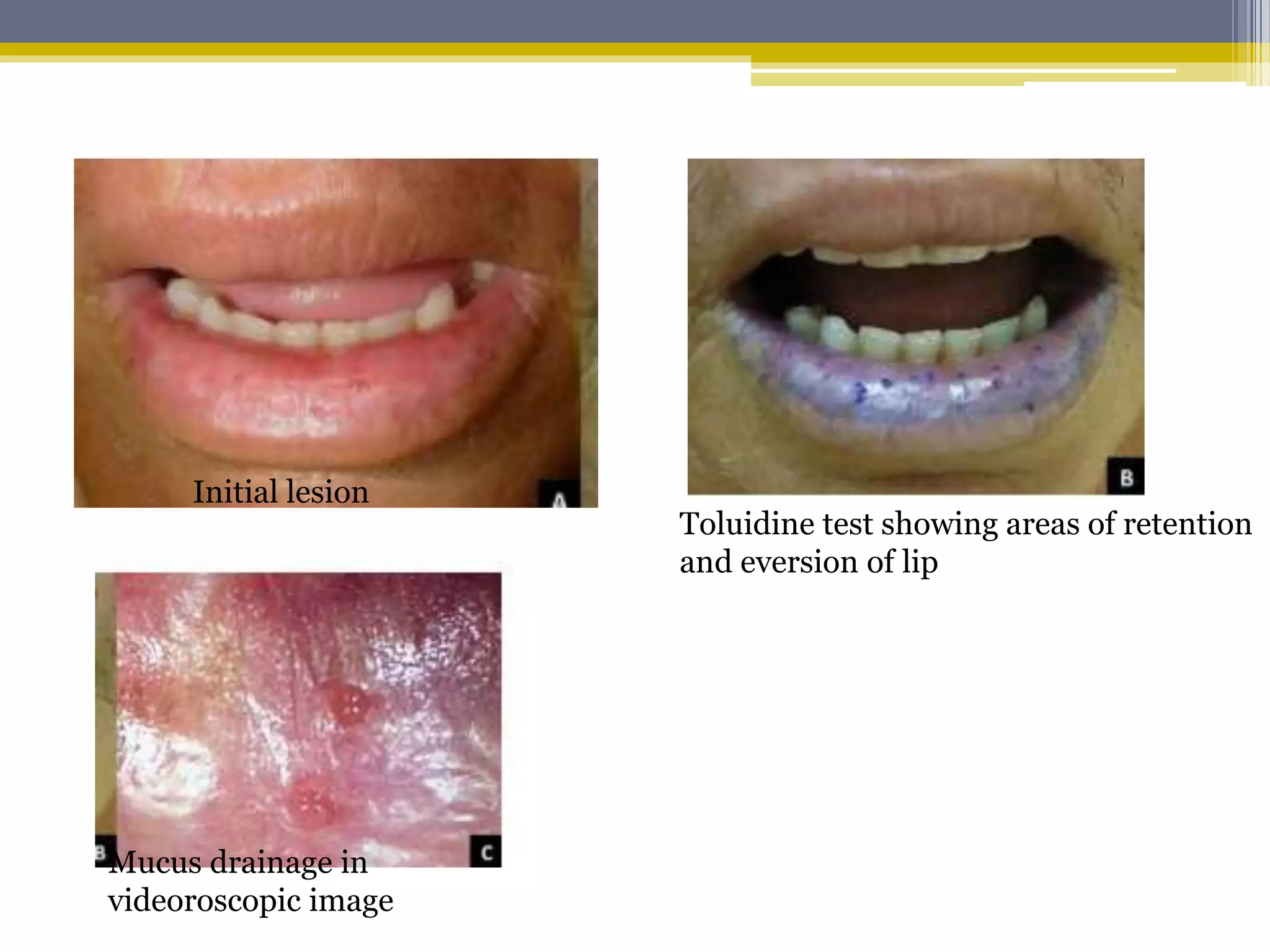Disorders of lip | PPTX