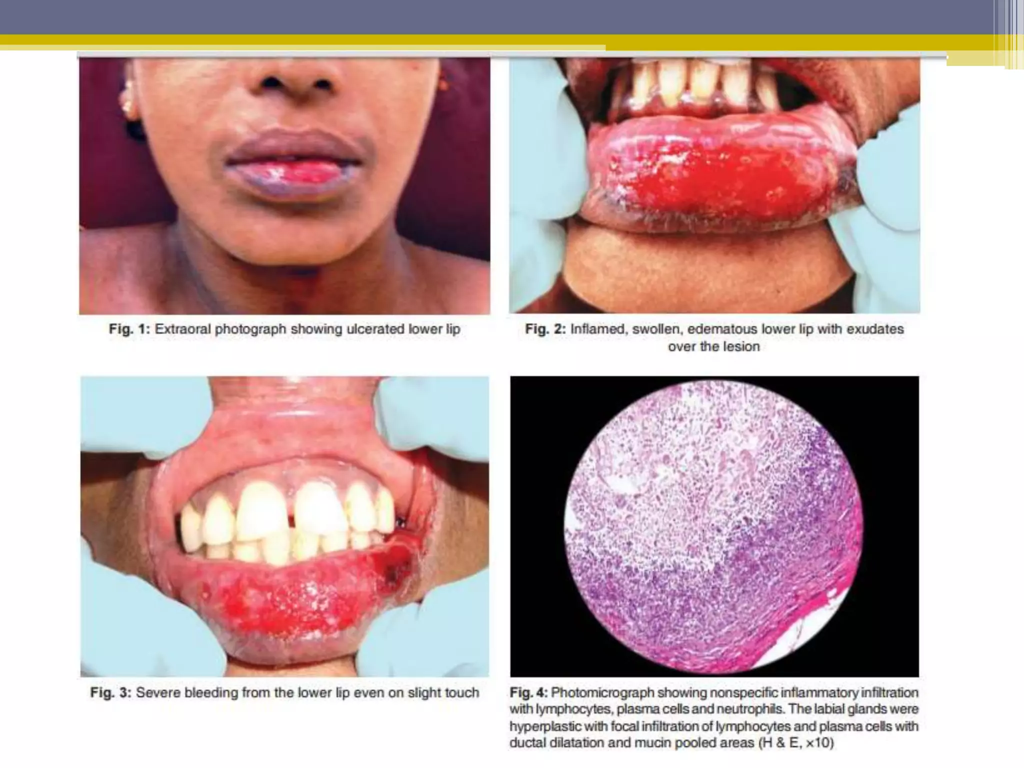 Disorders of lip | PPTX