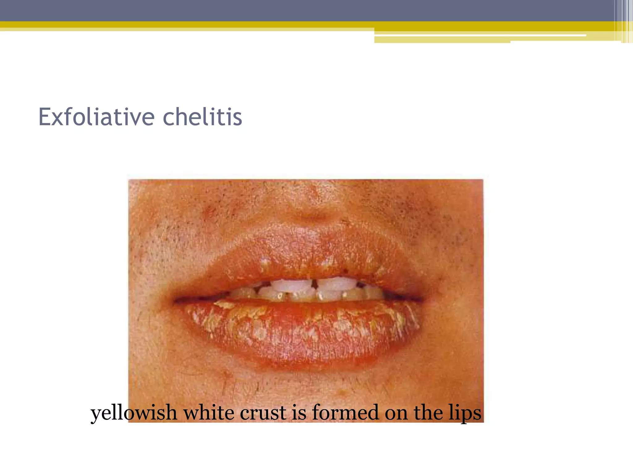 Disorders of lip | PPTX