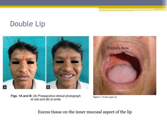Disorders of lip | PPTX