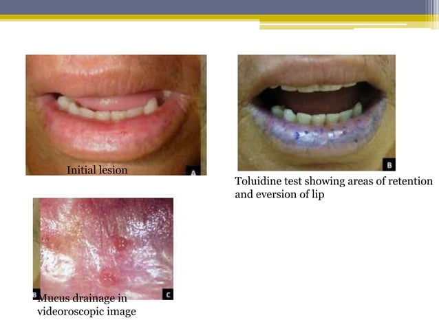 Disorders of lip | PPTX