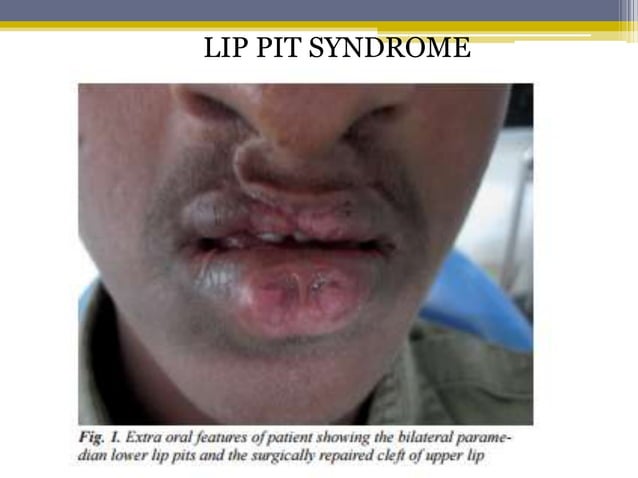 Disorders of lip | PPTX