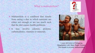 Disorders of malnutrition | PPTX