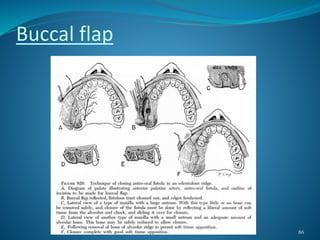 Disorders of Maxillary Sinus | PPTX