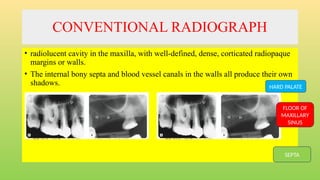 DISORDERS OF MAXILLARY SINUS.pptx- DR PRIYANKA | PPTX