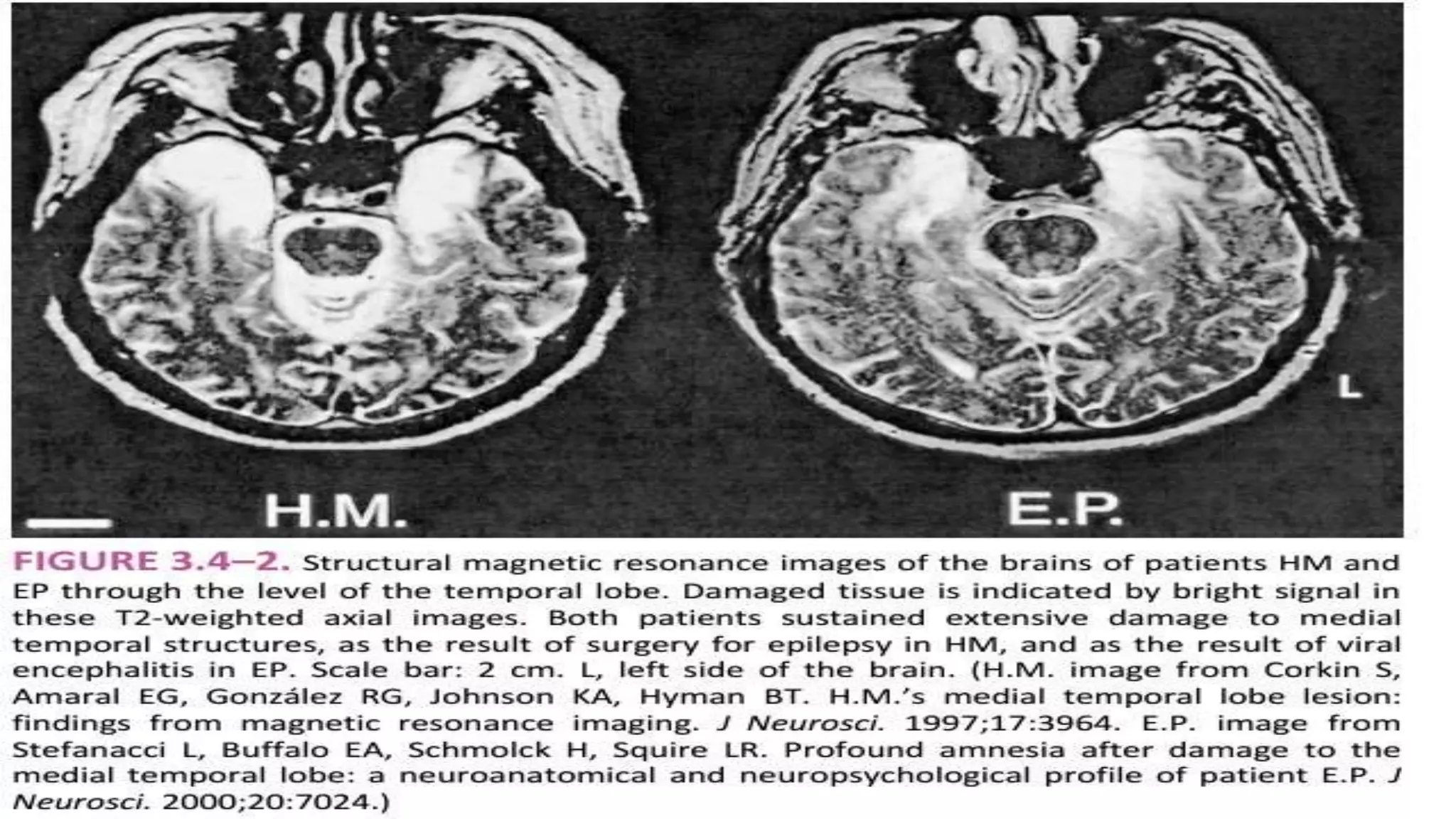 Disorders of memory | PPTX