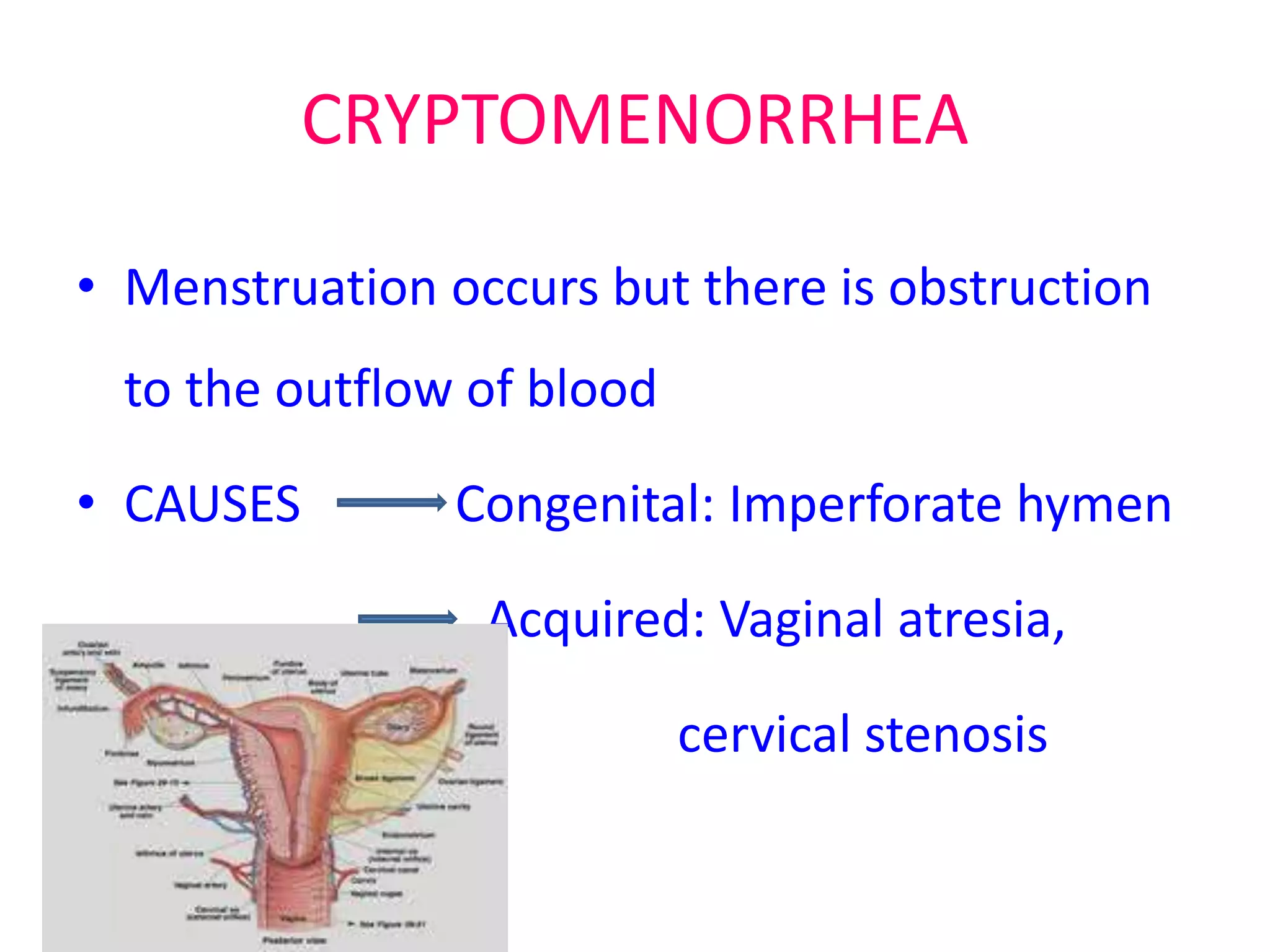 Disorders of menstruation | PPTX