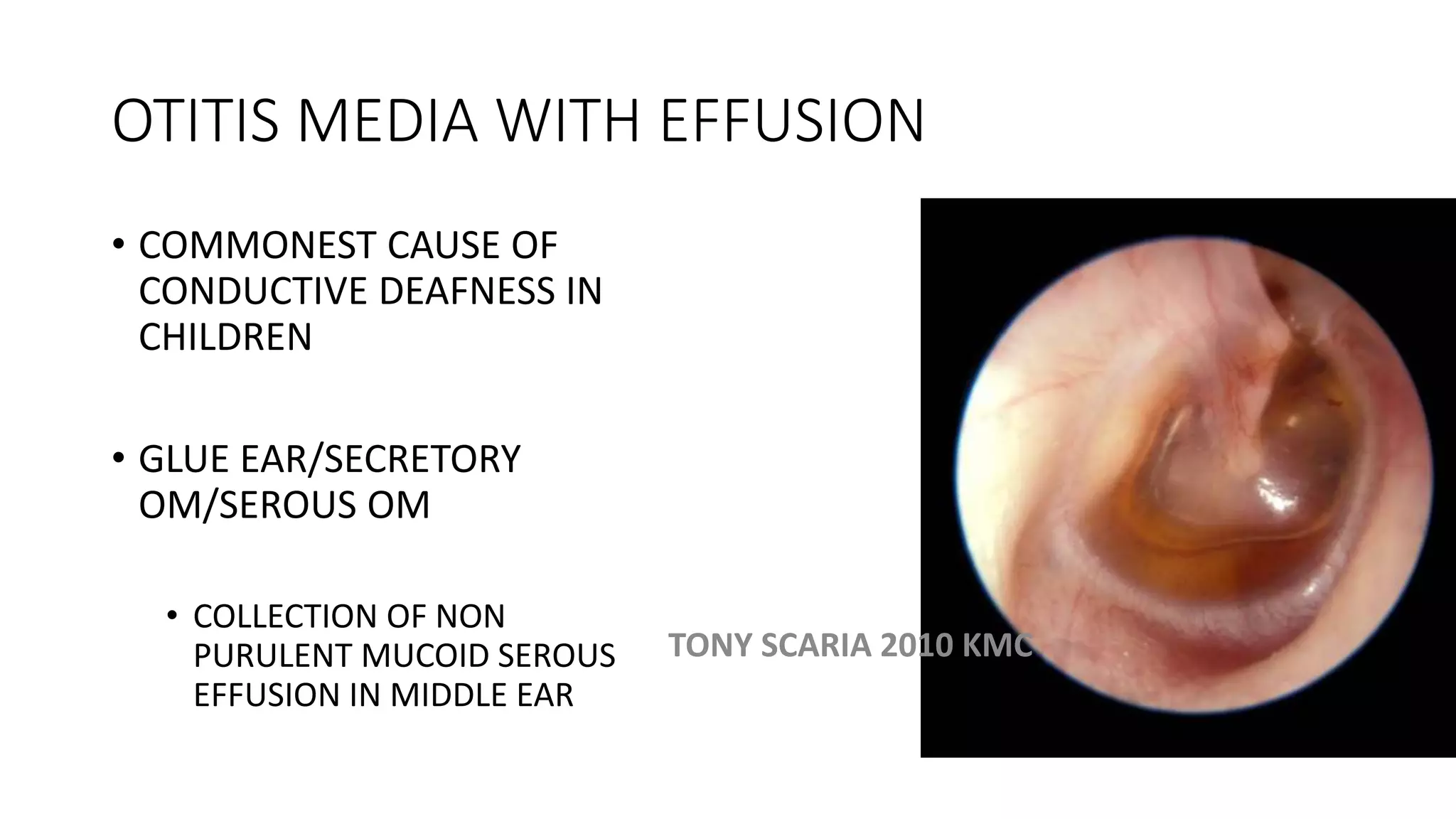 Disorders of middle ear revision notes | PDF