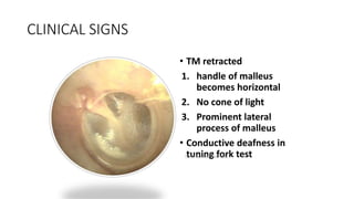 Retracted Tympanic Membrane